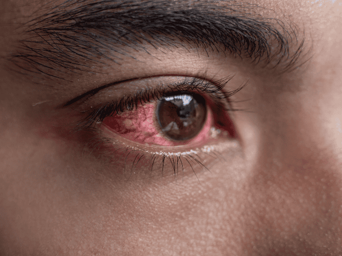 Picor de Ojos: Causas, Síntomas y Tratamientos Efectivos